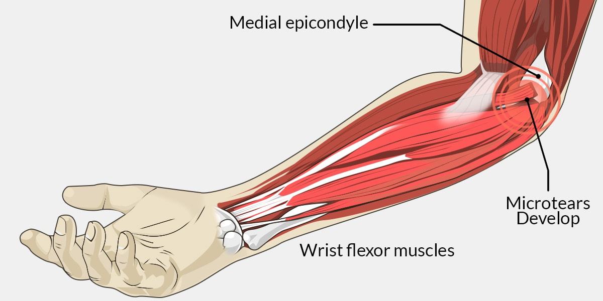 Suffering From Golfer s Elbow Are You Then Physiotherapy Is Your New